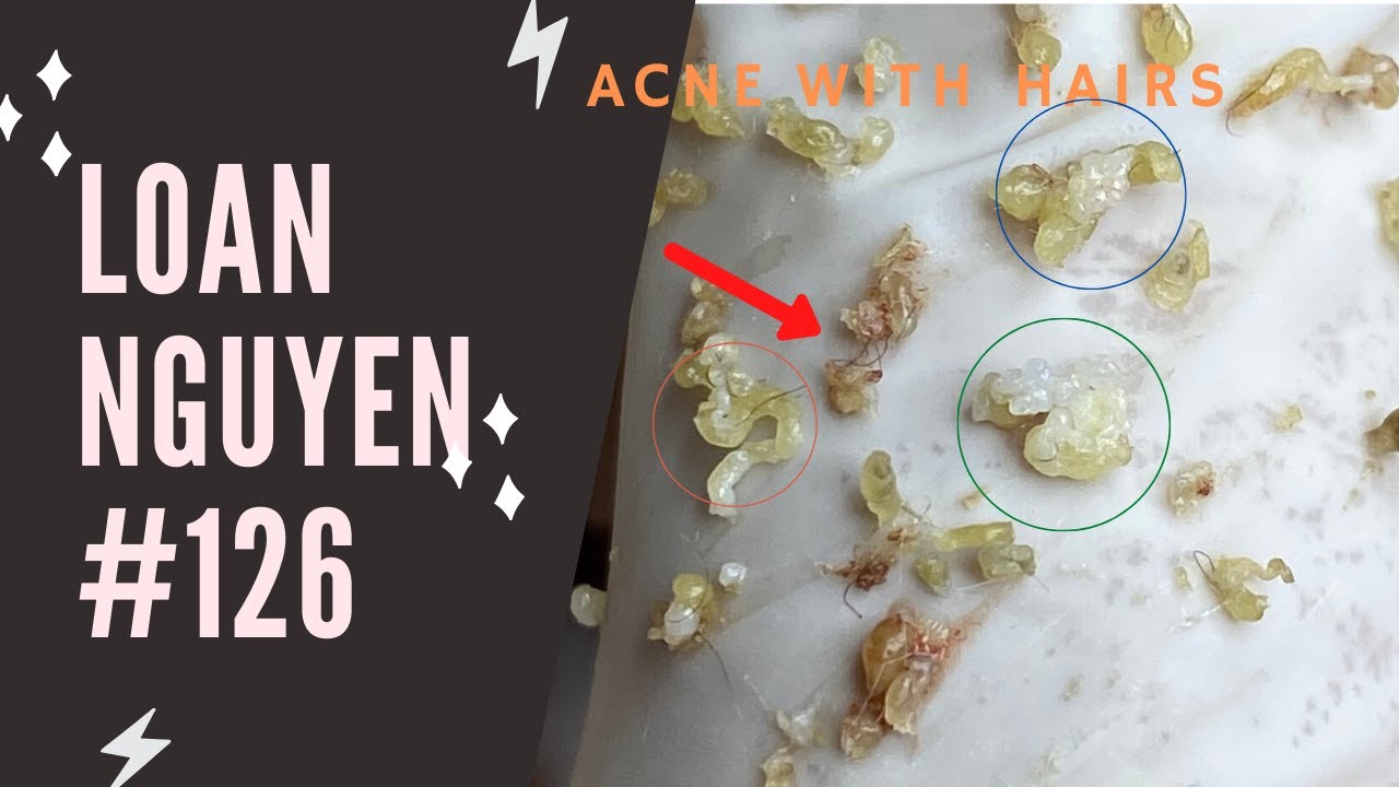 Ingrown hairs and acne - Pop That Zit - Since 2006!