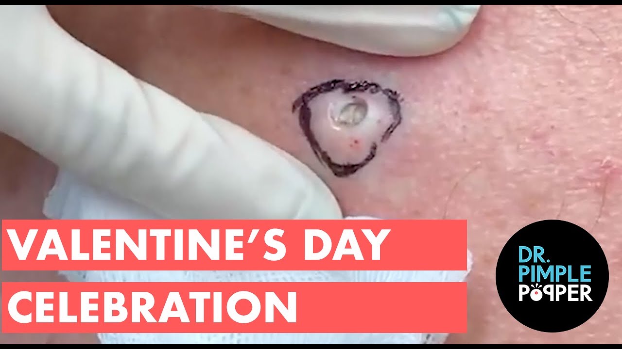 Valentine’s Day Pimples - Pop That Zit - Since 2006!