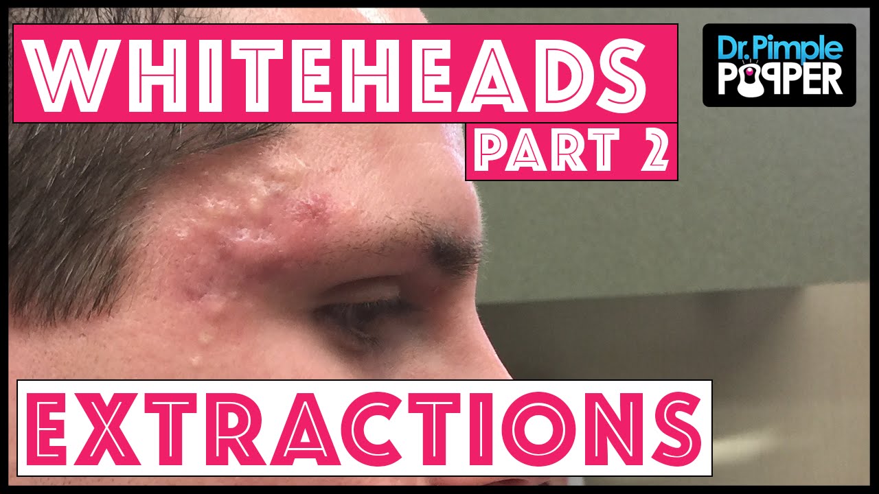 Face Full of Whiteheads - Pop That Zit - Since 2006!