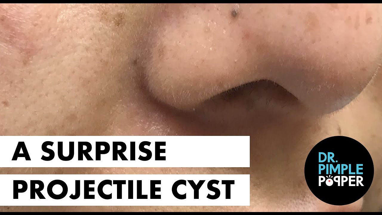 Pilar Cyst - Pop That Zit - Since 2006!