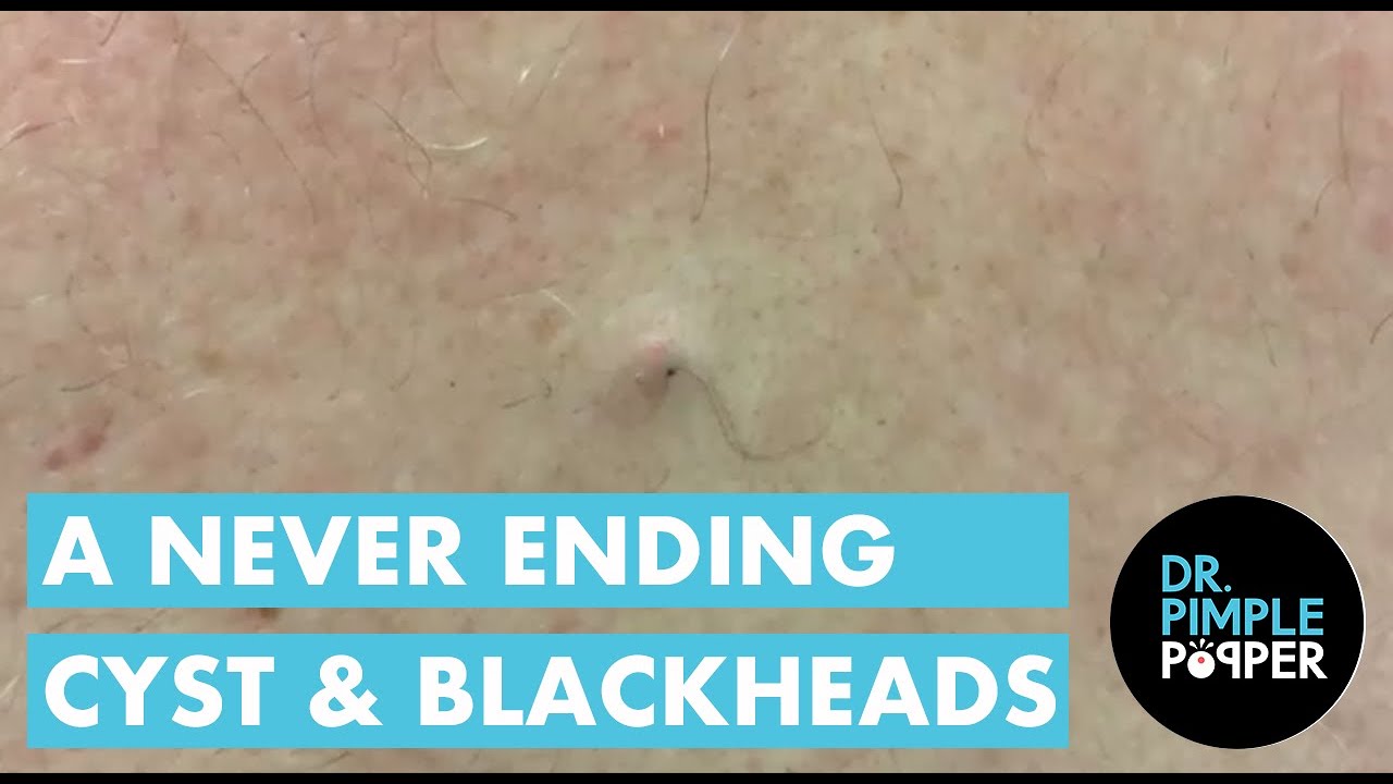 Cysts Revisited Pop That Zit Since 2006 Cysts Revisited Pop That Zit Since 2006